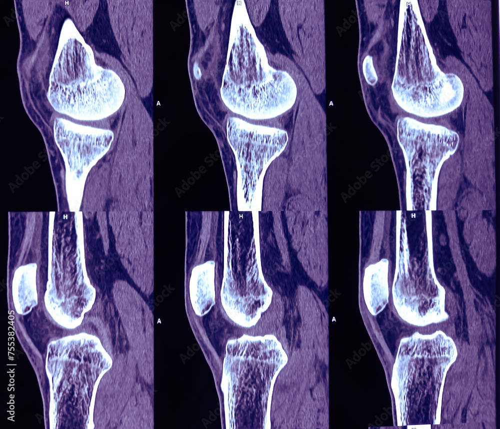 CT scan of Knee joint. knee joint alignment and congruity maintained ...