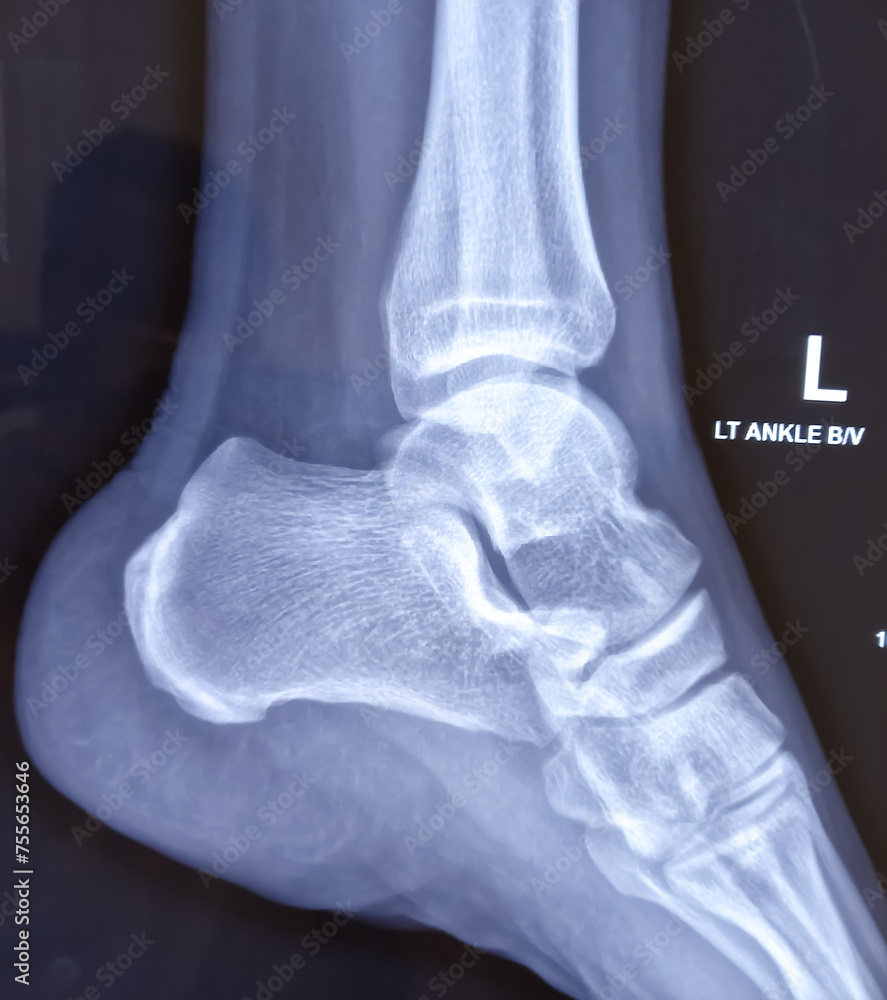 X-ray or radiograph of an ankle showing anatomy of bones and joint of ...