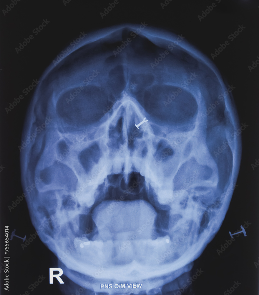 PNS X-ray OM view film, bilateral maxillary and frontal sinusitis with ...