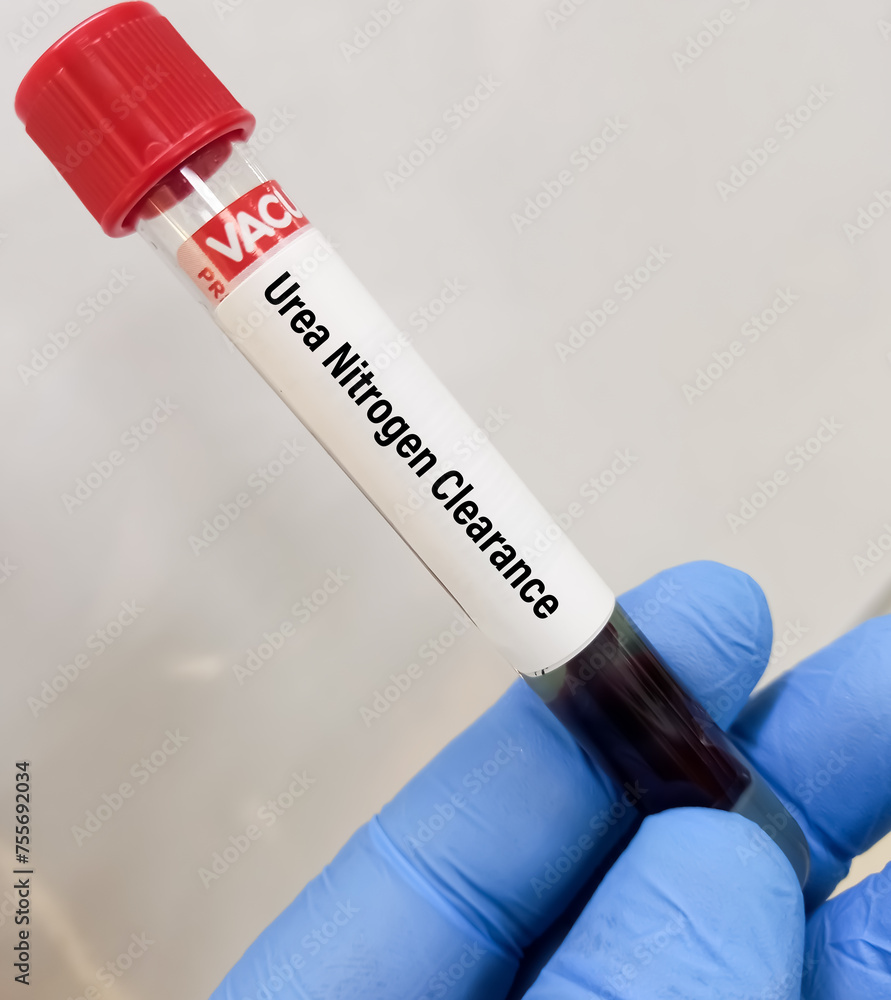 Blood sample for Urea Nitrogen Clearance for diagnosis of renal or ...