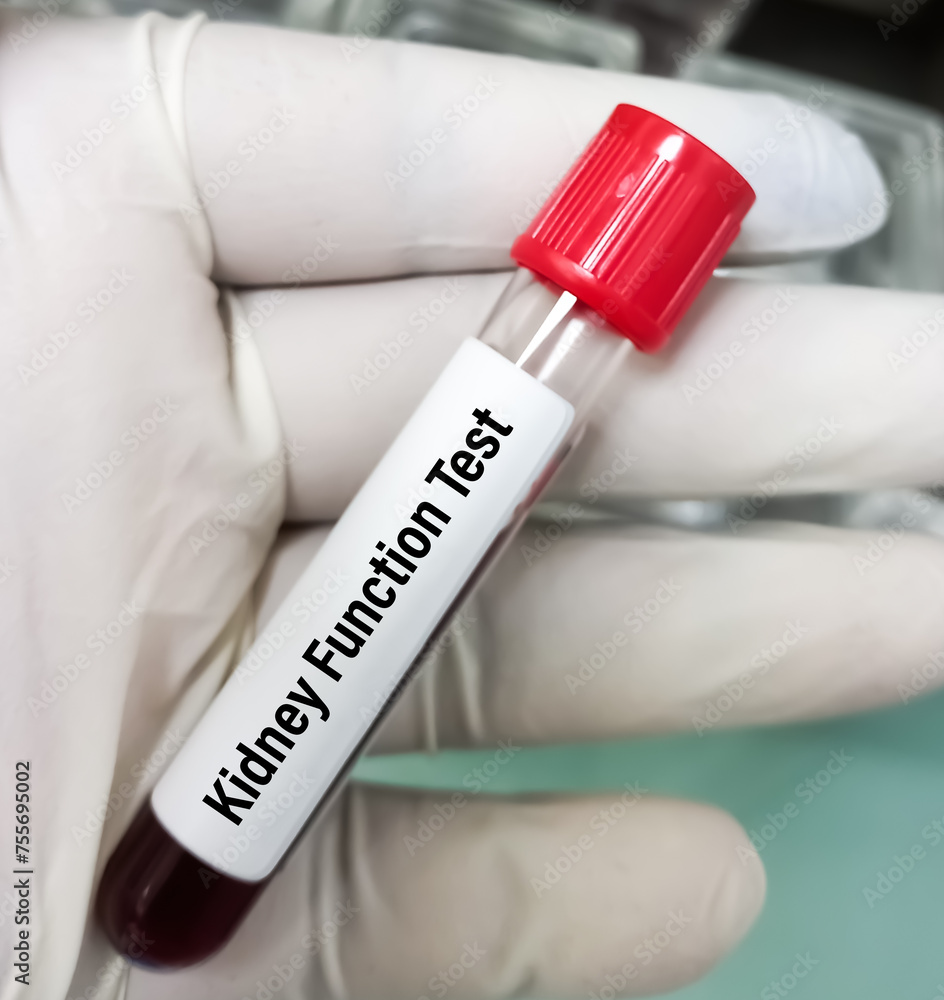 Blood sample for Renal Function test (Creatinine, BUN, eGFR, albumin ...