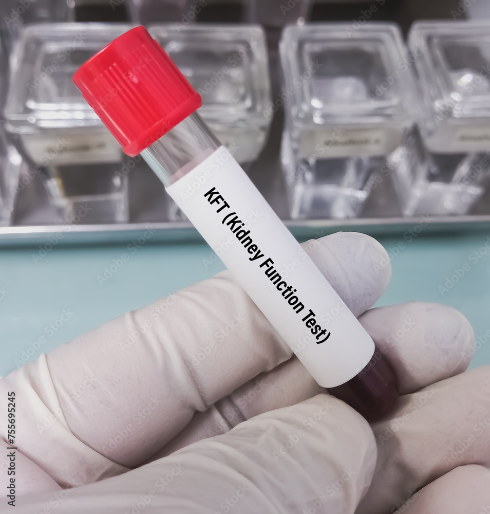 Blood sample for Renal Function test (Creatinine, BUN, eGFR, albumin ...