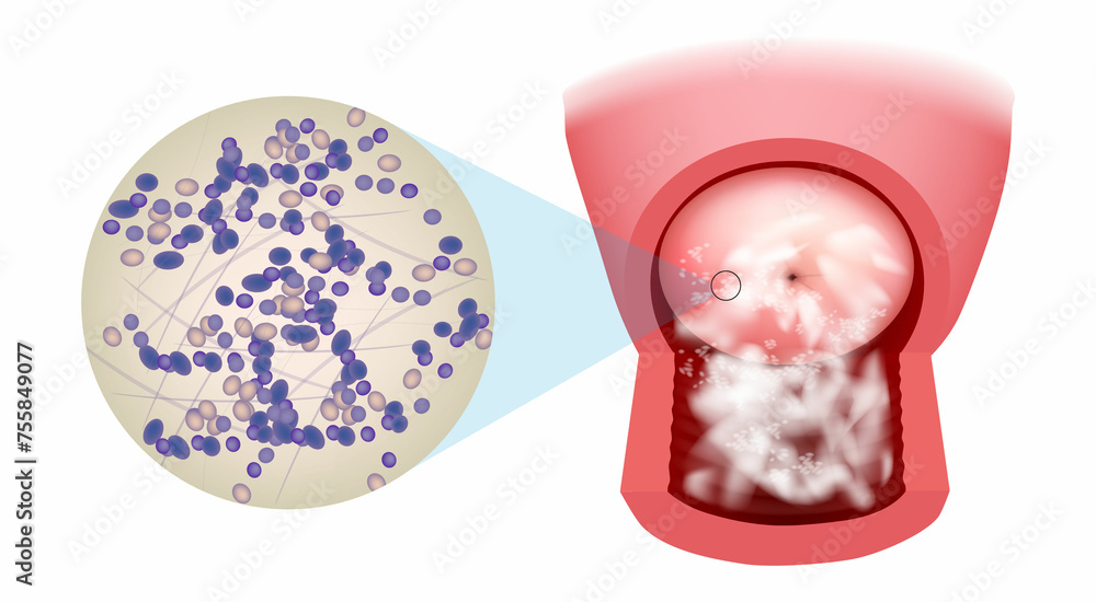 Illustration of a candidiasis infection on the cervix. Vaginal ...