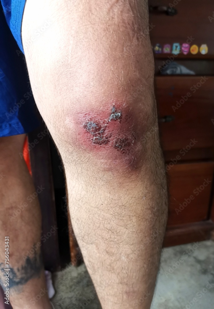 Pierna de una persona con abrasión o herida en la rodilla con signos de ...