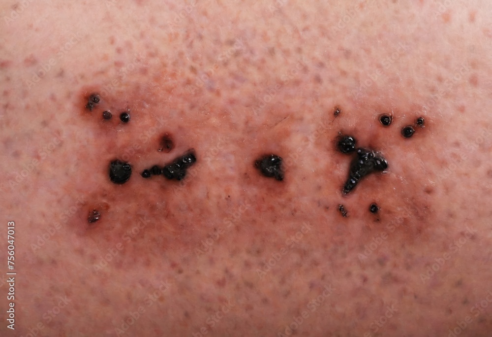 Pox, smallpox, mpox, pathogen, bacteria, biotechnology, bacterium ...