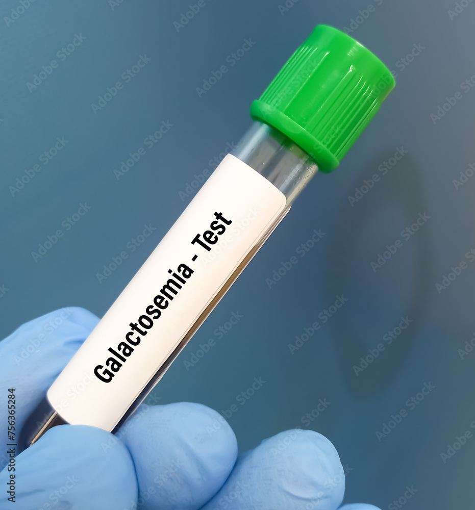 Blood sample for Galactose-1-phosphate uridylyltransferase (GALT) test ...
