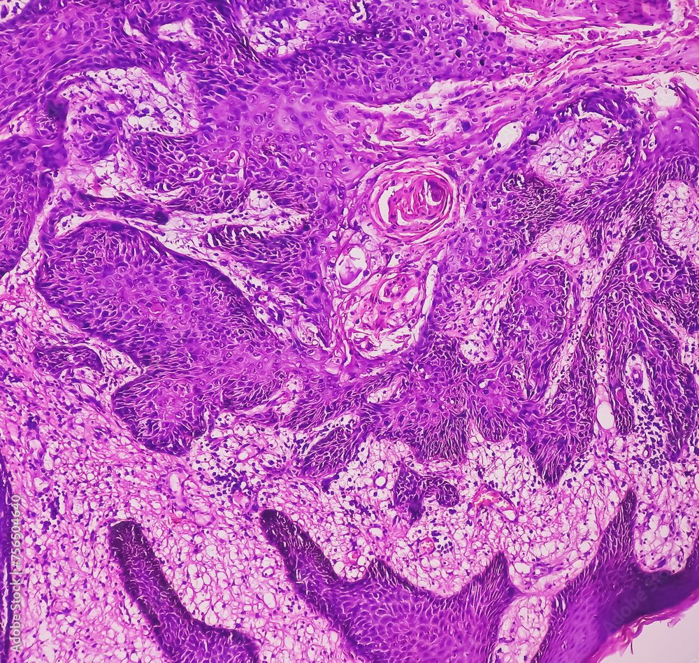 Tissue from axilla (biopsy). Invasive squamous cell carcinoma. Smear ...