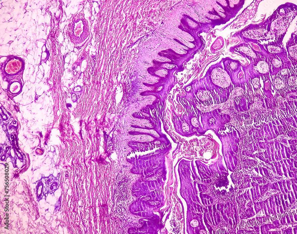 Tissue from axilla (biopsy). Invasive squamous cell carcinoma. Smear ...