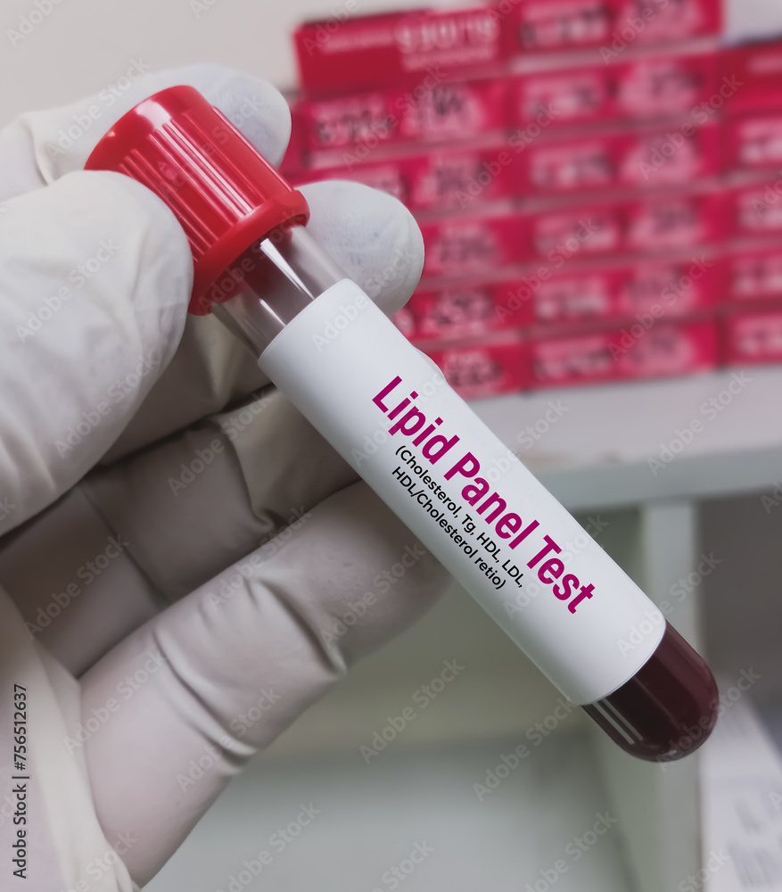 Blood sample for Lipid panel test, Cholesterol, Tg, HDL, LDL, HDL and ...