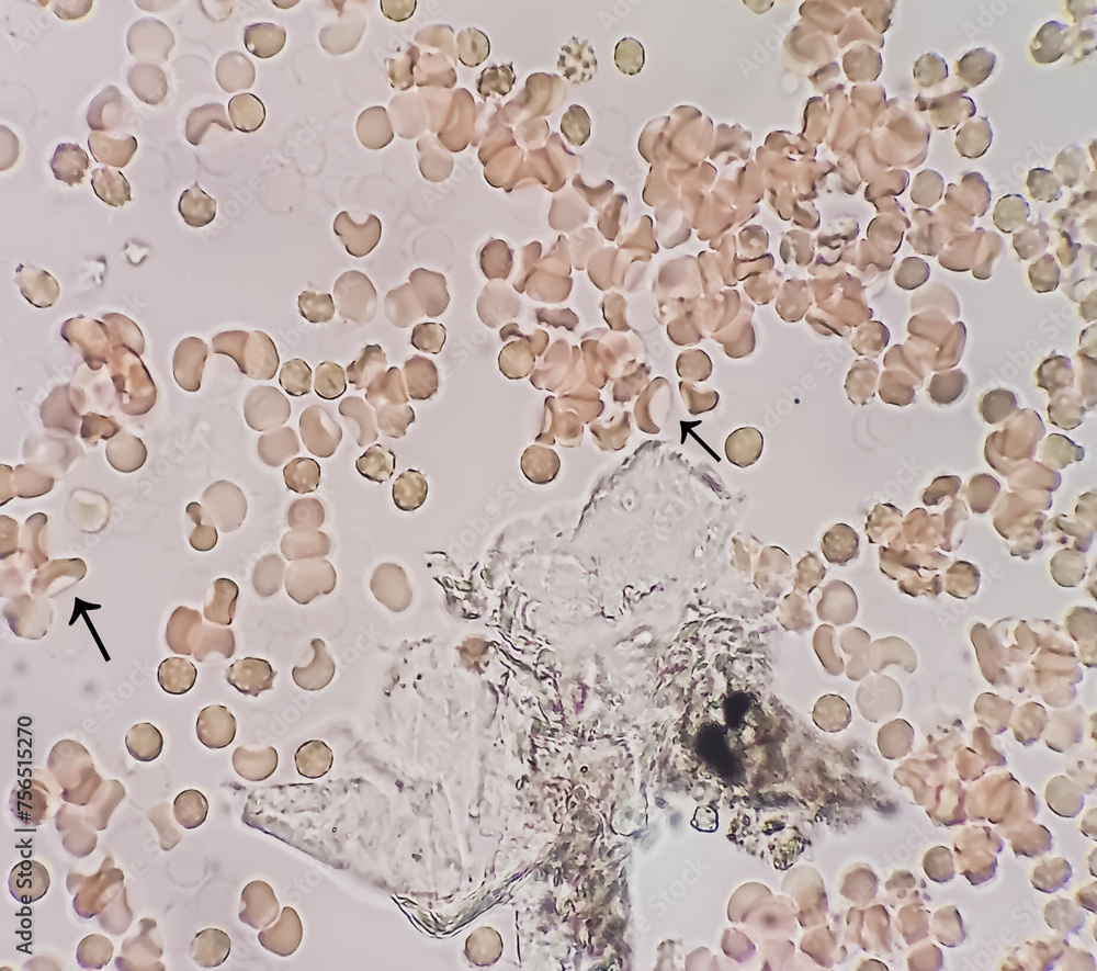 Photomicrograph of Sickle cell, sickling test. Sickle cell disease (SCD ...
