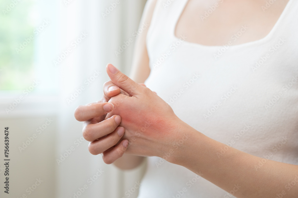 Dermatology asian young woman allergy, allergic reaction from atopic ...