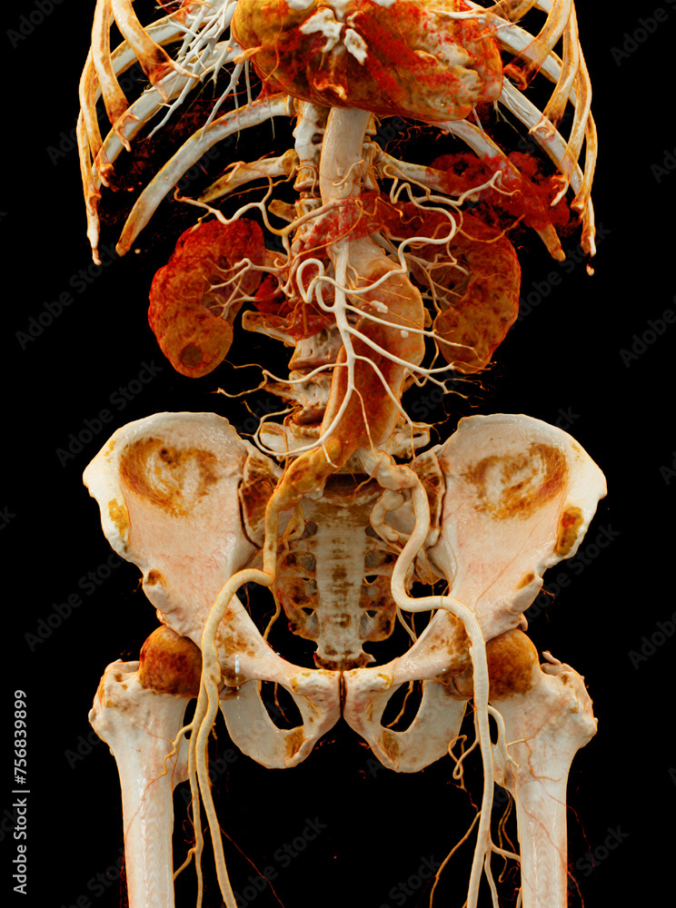 CTA abdominal aorta showing abdomenal aortic dissection 3D rendering ...