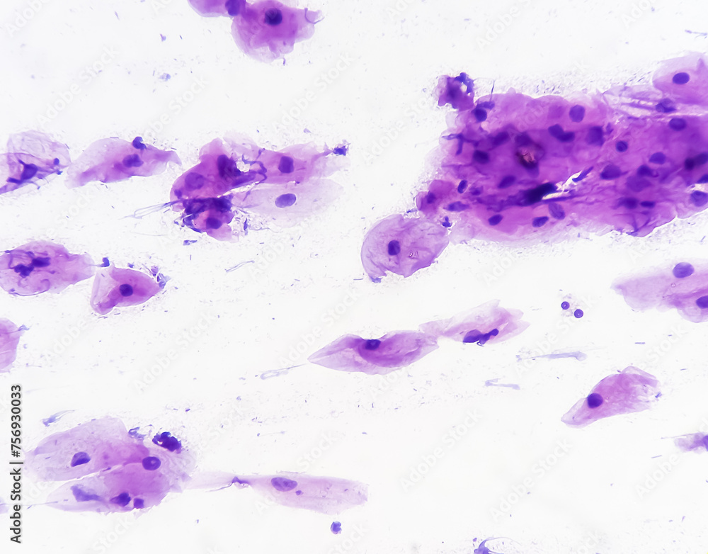 Light micrograph of Paps smear: Inflammatory smear with HPV related ...