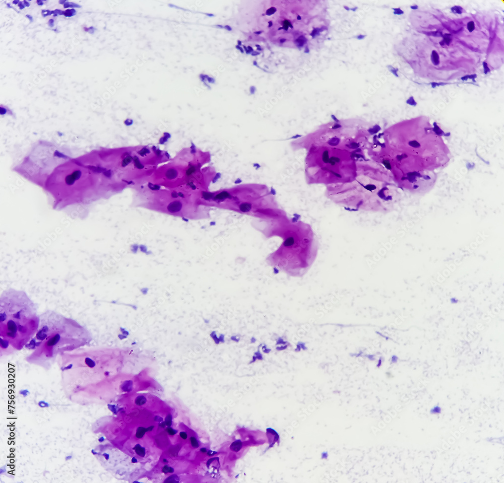 Light micrograph of Paps smear: Inflammatory smear with HPV related ...