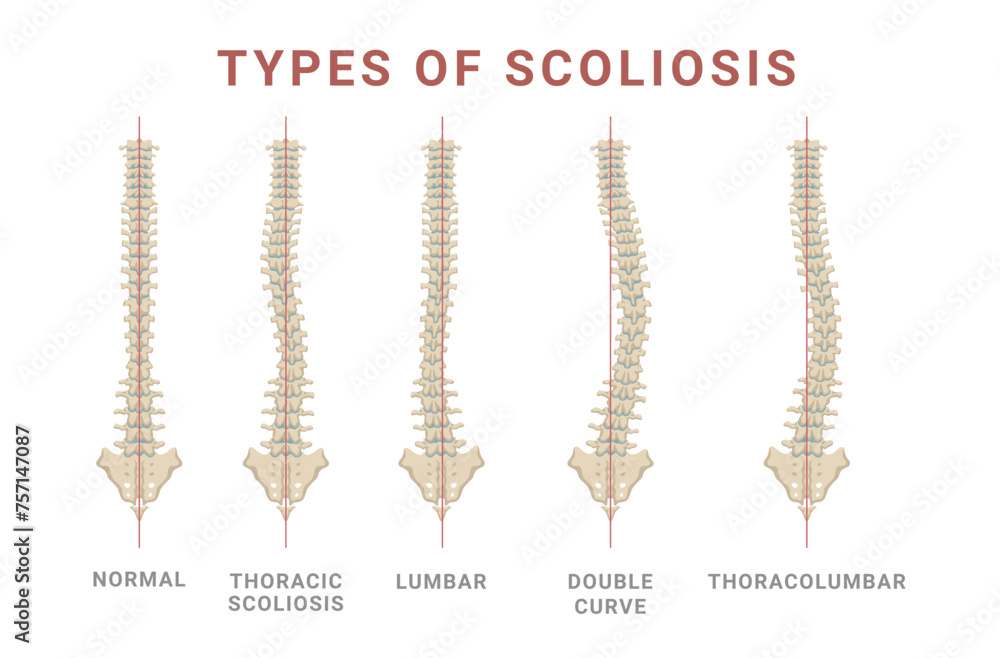 Scoliosis types spine skeleton normal and disease structure with names ...