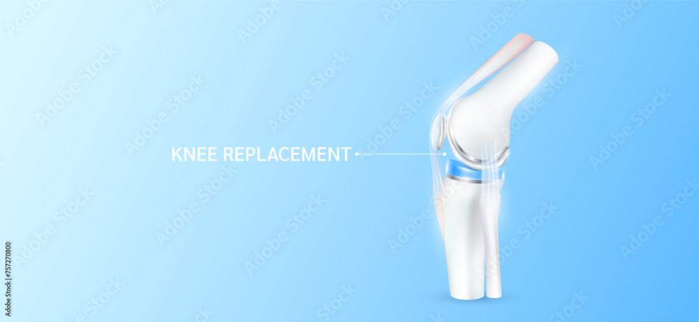 Total knee replacement or implant for treatment relieve arthritis ...
