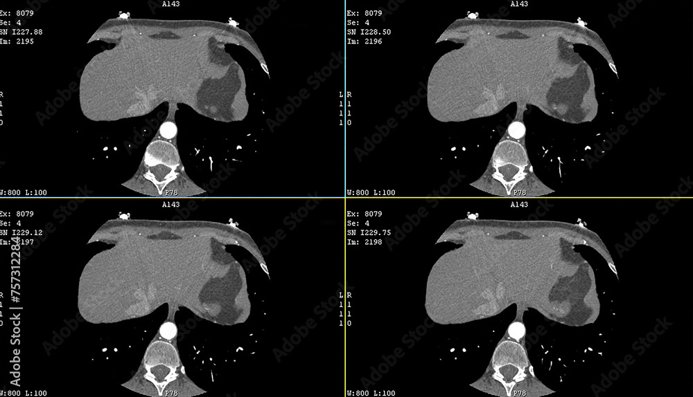 A computerized tomography CT coronary angiogram. Axial contrast of the ...