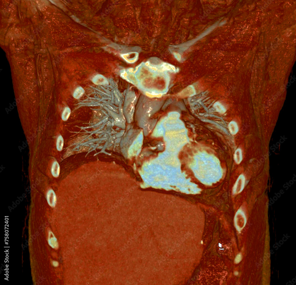 Cta Thoracic Aorta 3d Rendering Offers Detailed Visualization