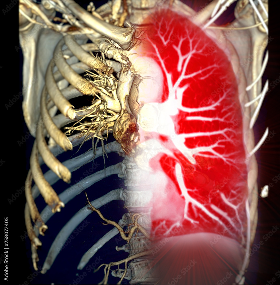 Cta Thoracic Aorta 3d Rendering Offers Detailed Visualization