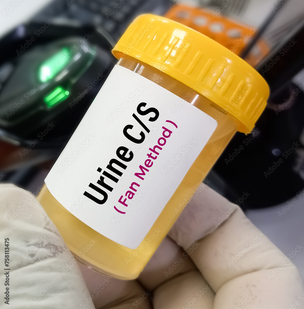 Urine sample for Culture and sensitivity test. Urine cs by Fan method ...