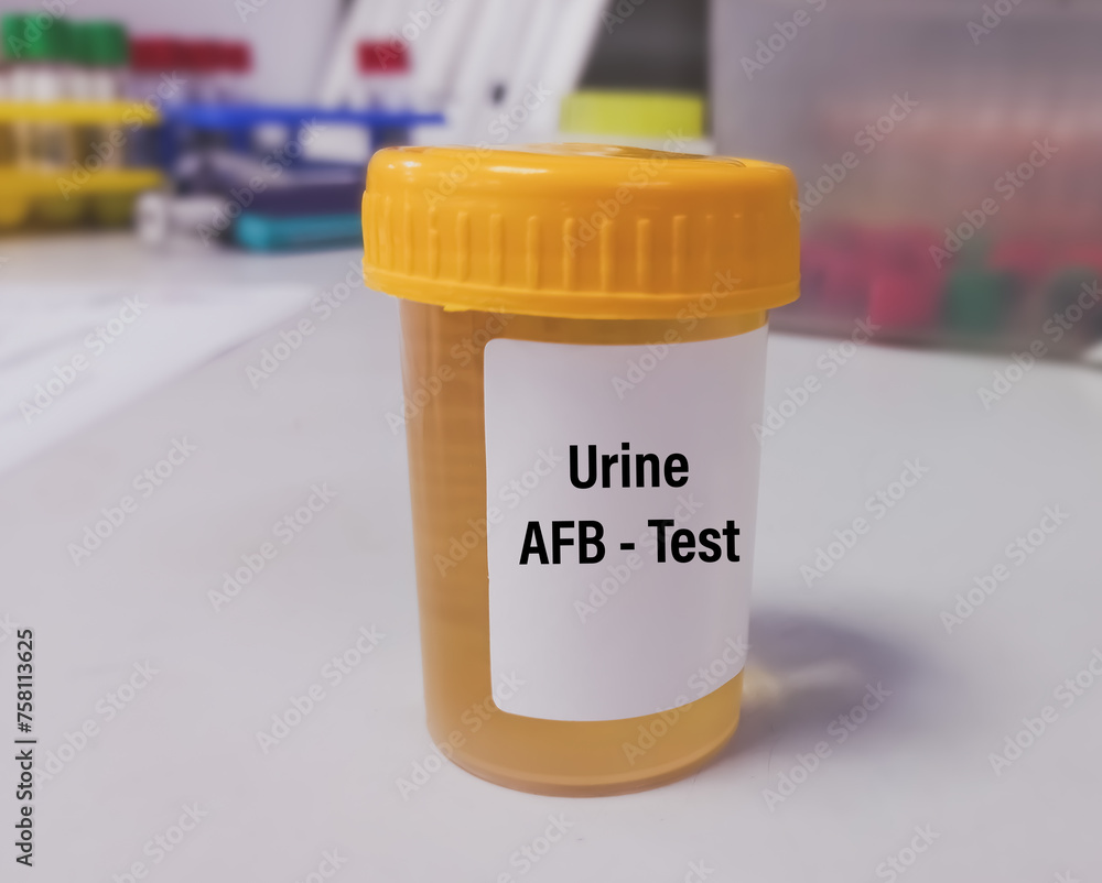 Urine sample for AFB (Acid-Fast Bacillus) test, to diagnosis of ...