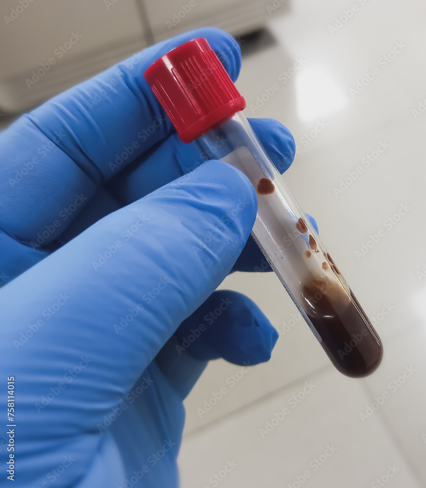 Synovial Fluid sample for ADA levels. to diagnosis of Tuberculosis (TB ...