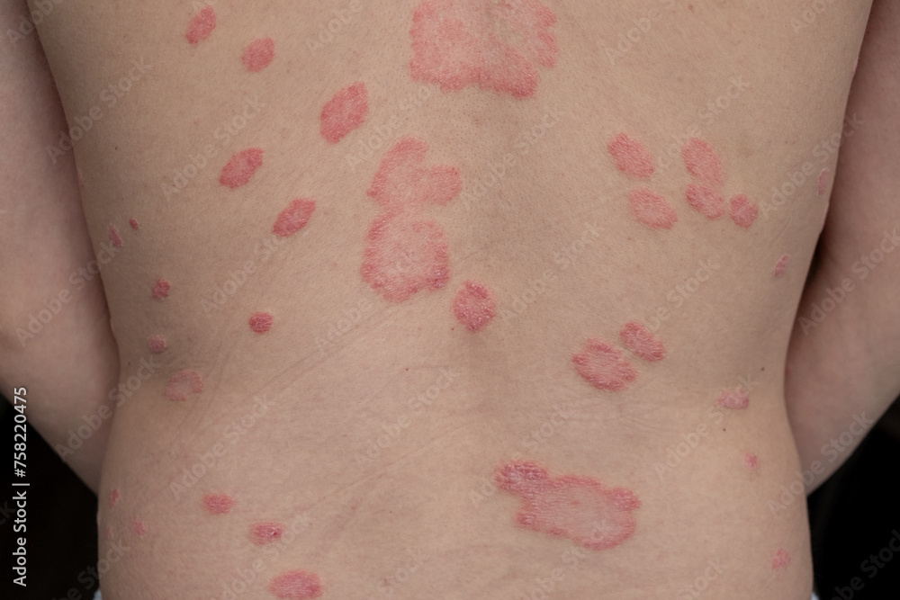 Psoriasis Vulgaris, skin patches are typically red, itchy, and scaly ...