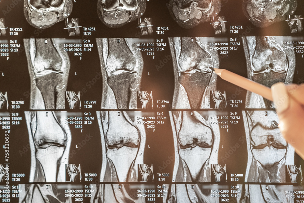 Knee joint x-ray or MRI. Doctor pointed on area of knee joint, where ...