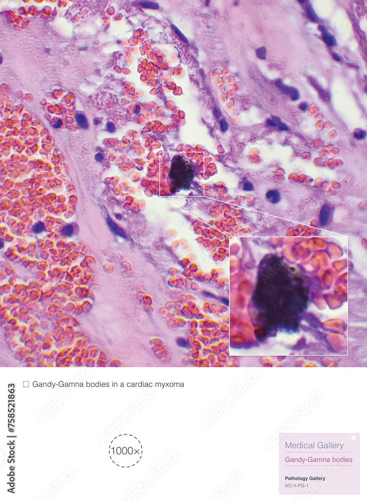 Gandy-Gamna bodies are pathological changes involving hemosiderosin and ...