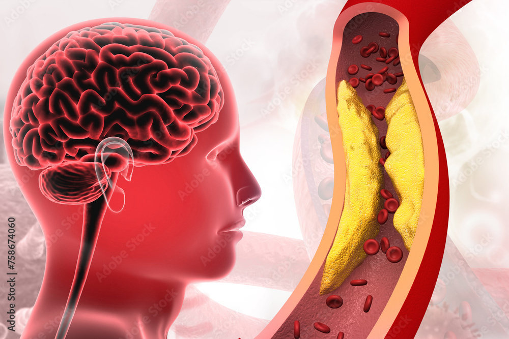Human brain stroke concept. Clogged vein in brain. 3d illustration ...