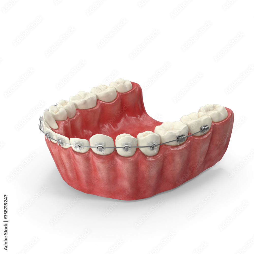 Human Lower Jaw Model Featuring Self-Ligating Transparent Dental Braces ...