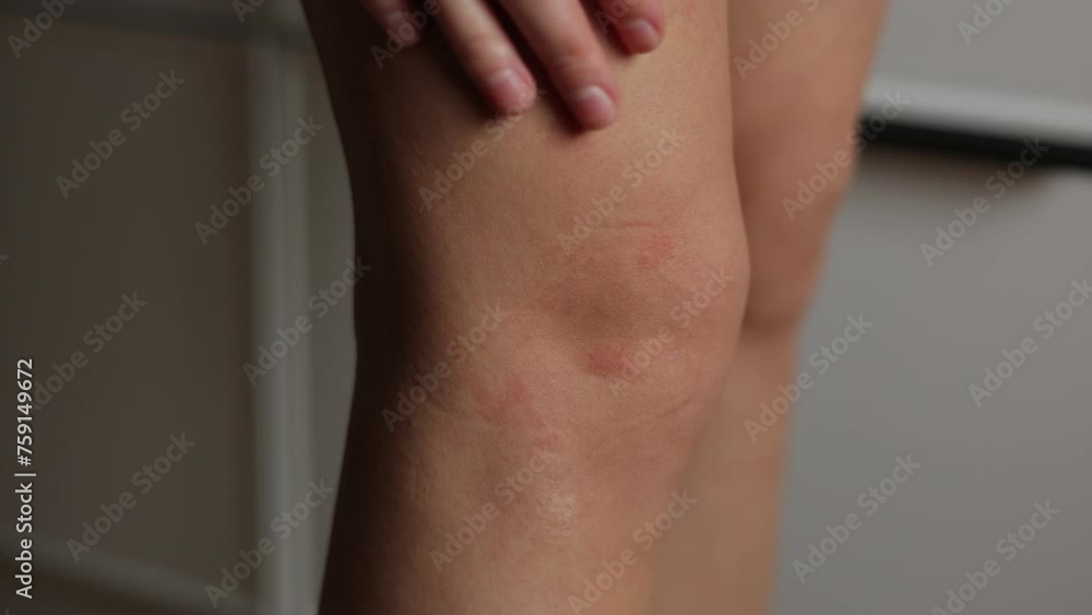 Allergic rash dermatitis eczema on woman leg. Female runs hand along ...