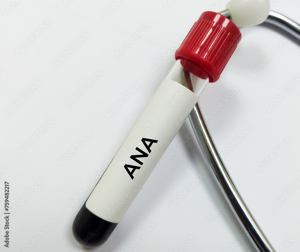 Blood sample for ANA (antinuclear antibody) test, autoimmune disease ...