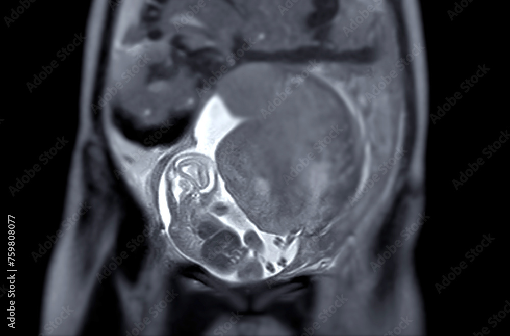 MRI during pregnancy ensures non-invasive evaluation of fetal health ...
