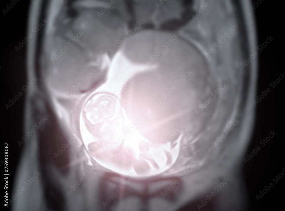 MRI during pregnancy ensures non-invasive evaluation of fetal health ...