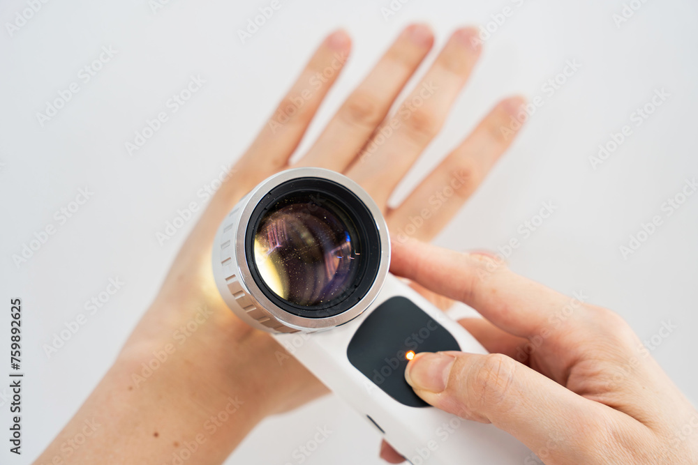 Overhead image of hands are using a dermatoscope to examine nevi (moles ...