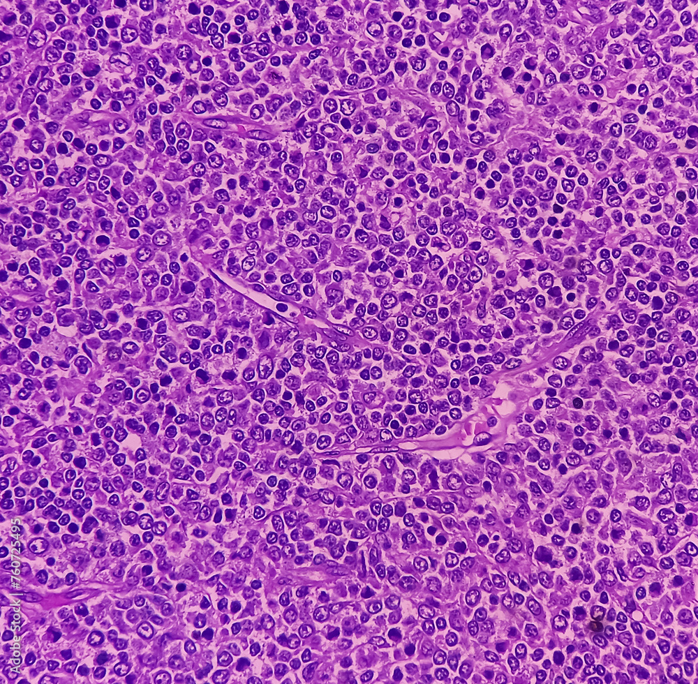 Cervical lymph node(biopsy): Non-Hodgkin's lymphoma-high grade. Light ...