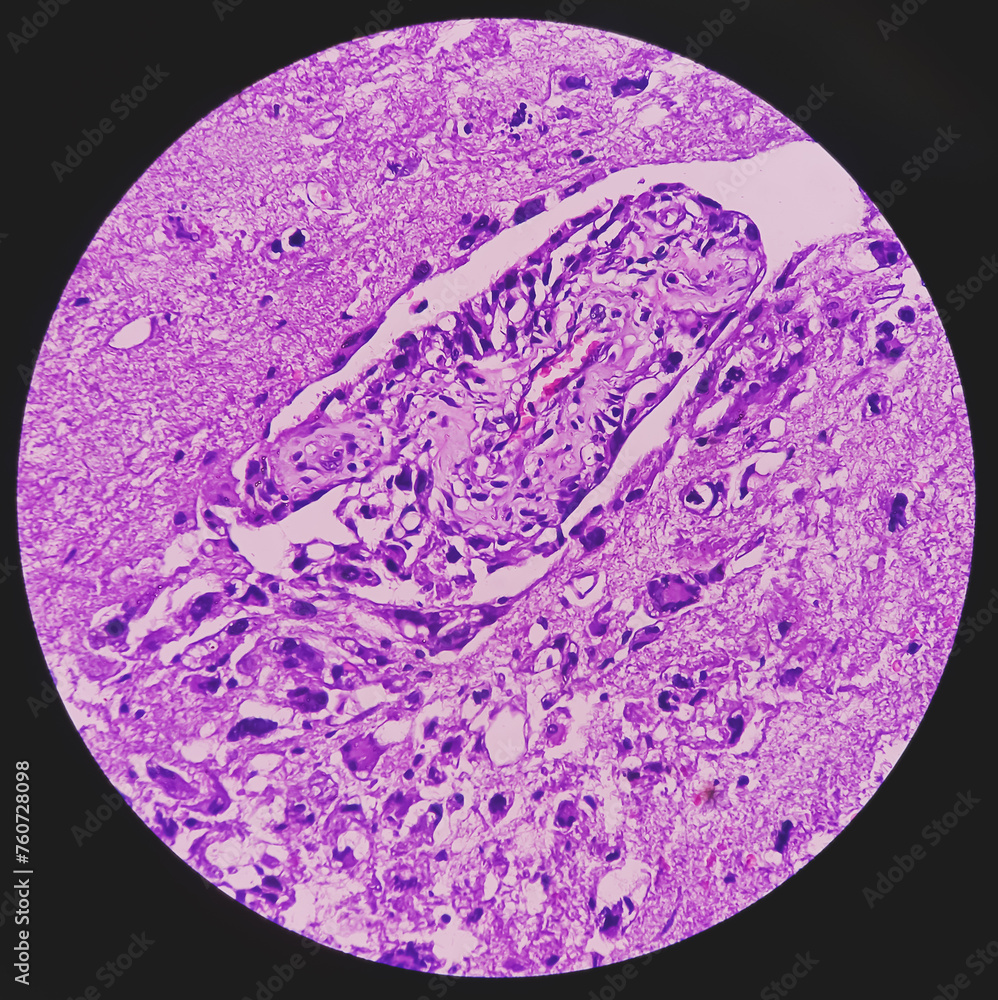 Kidney cancer: Microscopic image of metastatic clear cell carcinoma of ...