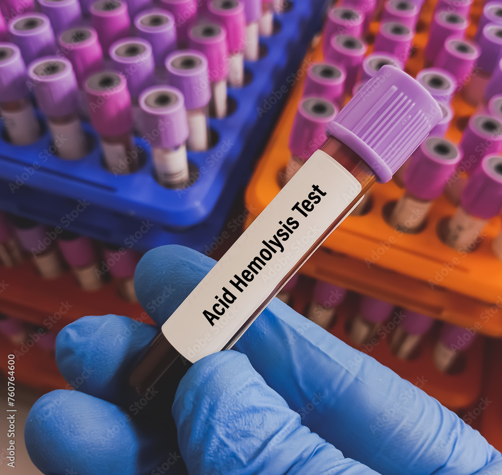 Blood sample for Acid Hemolysis test, to diagnose paroxysmal nocturnal ...