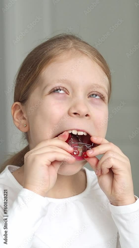 Vidéo Stock Large children's teeth with a dental plate. Braces system ...