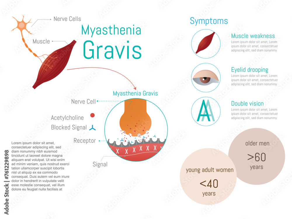 Infographics of myasthenia gravis disease.diagram of the nerve cell how ...
