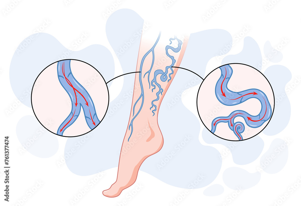 Varicose veins. Blue blood vessel visible through the skin, abnormally ...