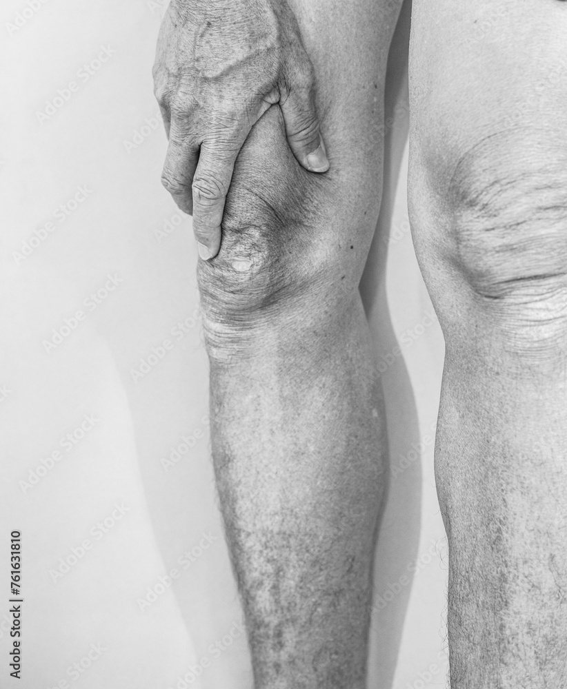 body parts Calluses and rough skin on legs and knees. of the elderly ...