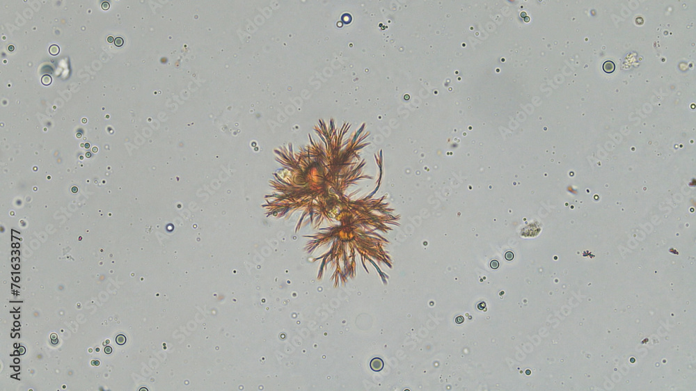 Bilirubin crystals in urine, seen under a 400X microscope Stock ...