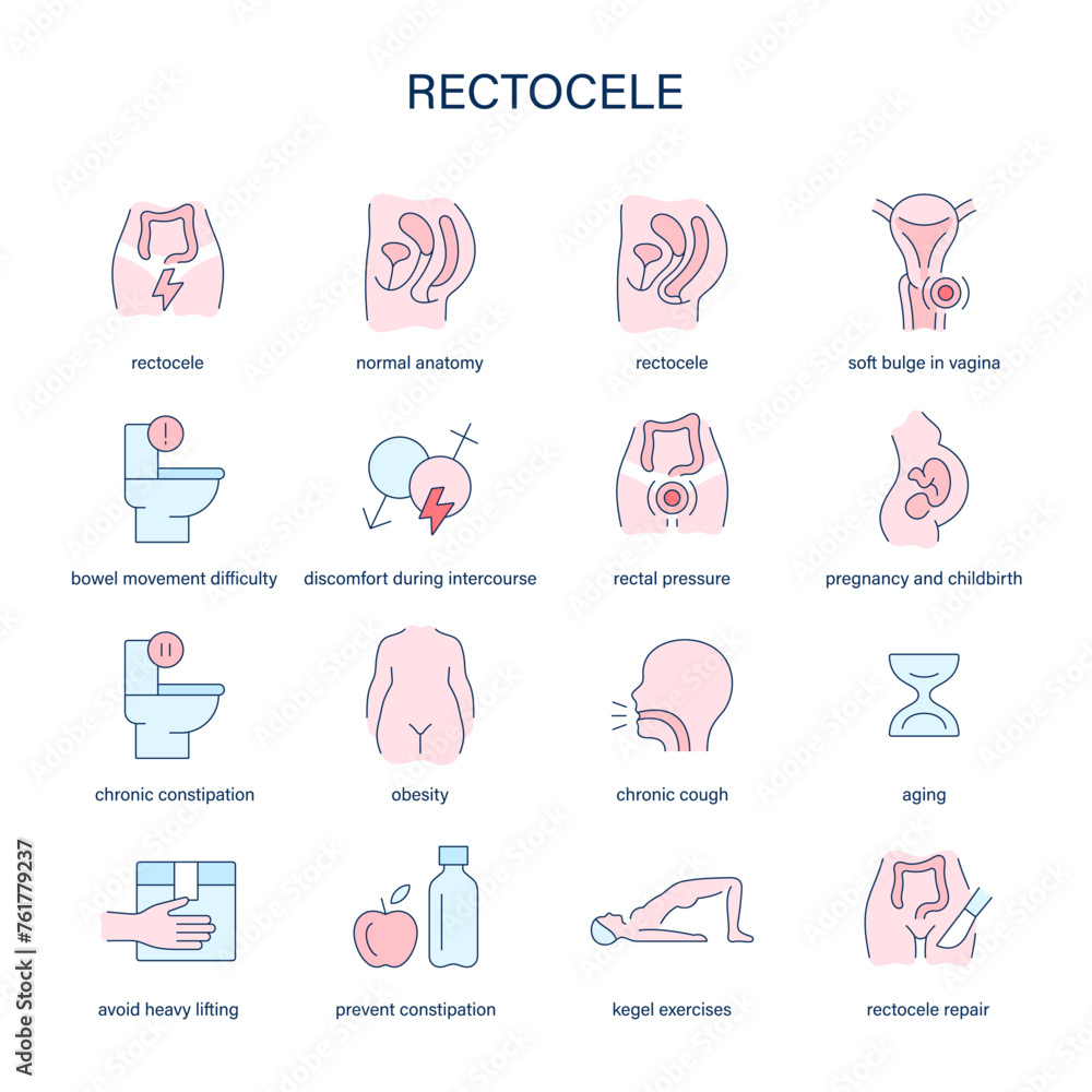 Rectocele symptoms, diagnostic and treatment vector icons. Medical ...