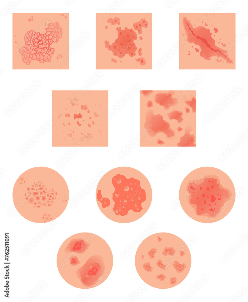 Different types of psoriasis set. Part of patients skin with dermatitis ...