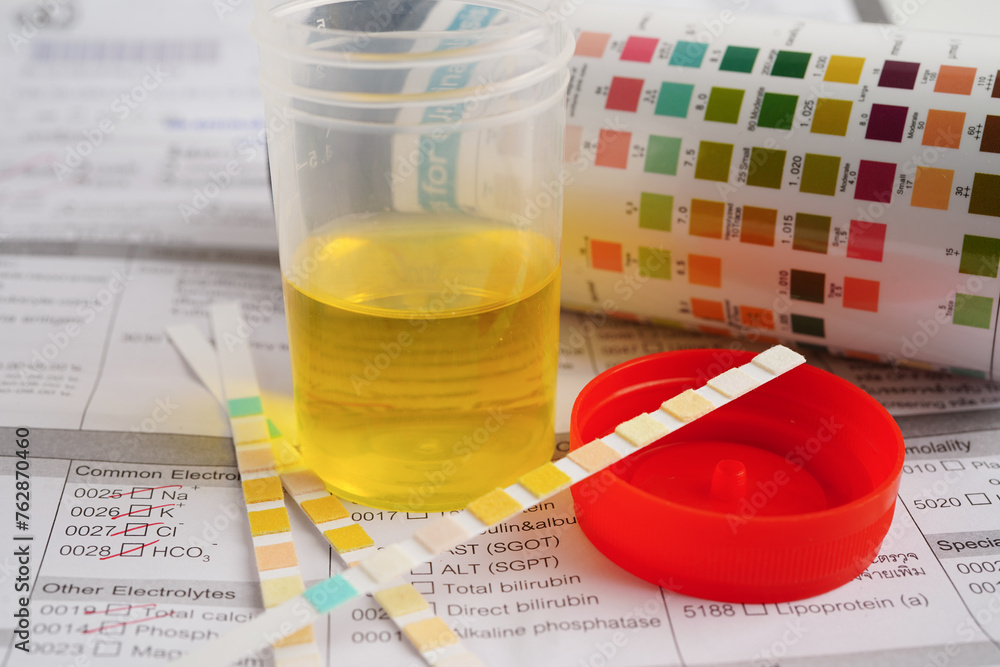 Urinalysis, urine cup with reagent strip pH paper test and comparison ...