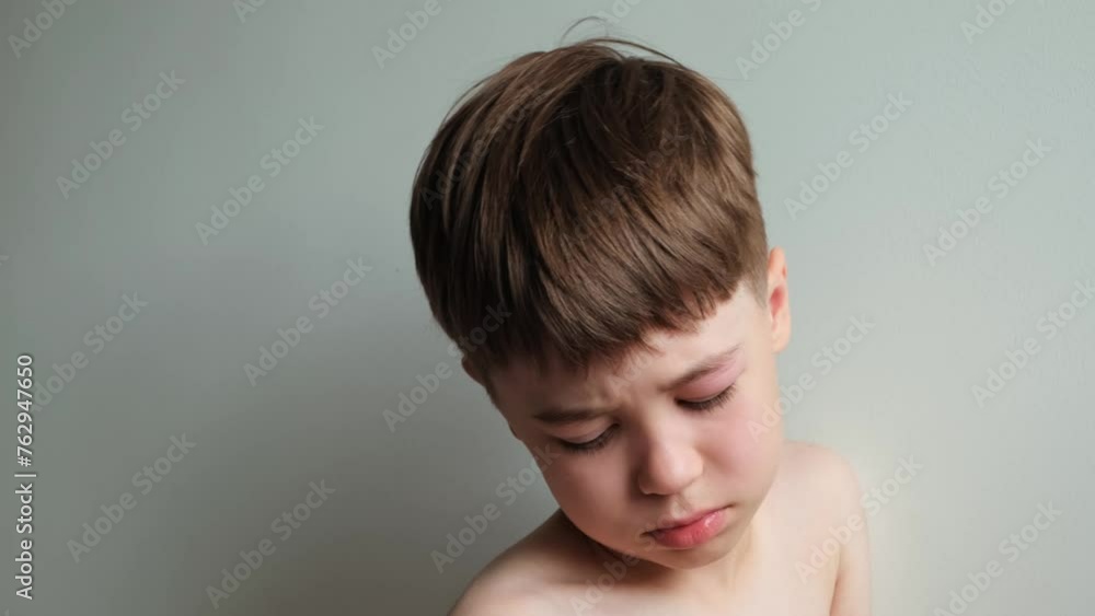 Portrait of unhappy boy looking at the camera with swollen eye from an ...