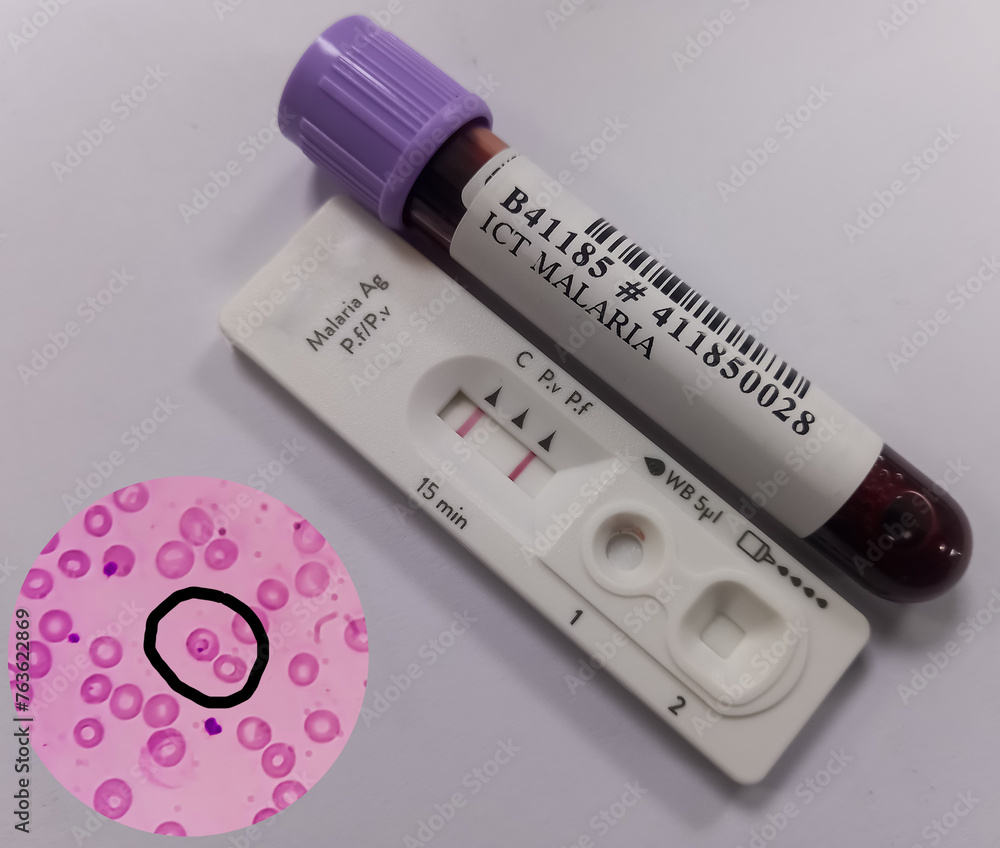 Malarial Parasite(MP) Test, Medical check up test, to identified by ...