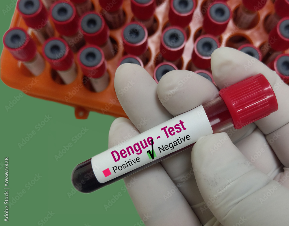 Close view of technician hand hold blood sample for dengue virus (IgG ...